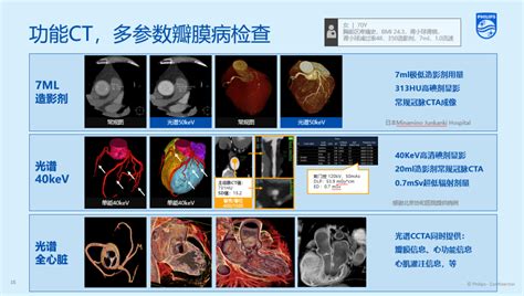 声光并举：飞利浦准分子激光消蚀术 心脏多模态功能影像解决方案亮相occ 2023 严道医声网