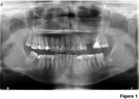 Caso N° 30 Sinusitis Maxilar Radiodontica Ar