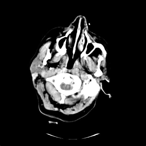 Brain Hemorrhage Detection Classification Dataset By National Textile University Faisalabad