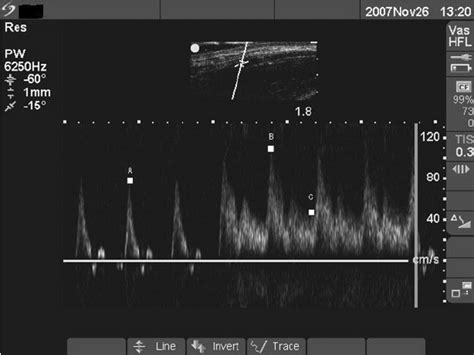 Spectral Doppler Waveform In A Normal Radial Artery During Ischaemia Download Scientific