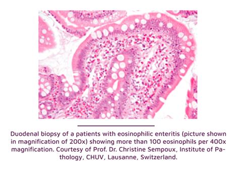 Snegid Eosinophilic Gastritis Eosinophilic Enteritis And