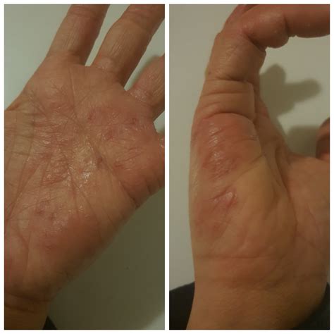 Dyshidrotic Dermatitis Symptoms Causes And Treatment Shti