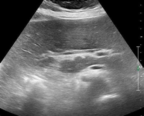 Common Hepatic Duct Ultrasound