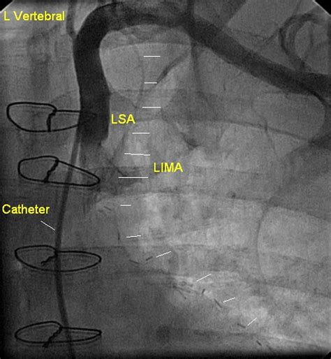 Occluded Left Internal Mammary Artery Lima Graft