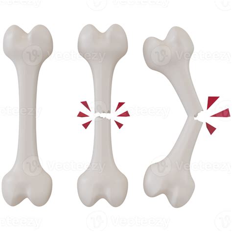 3d Rendering Of Broken Bones In Different Stages 11659442 Png
