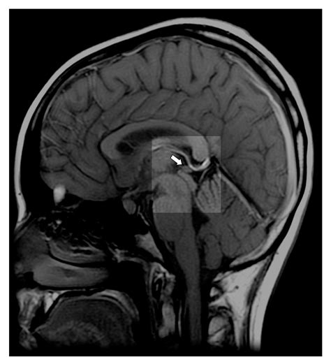 Pineal Gland Mri