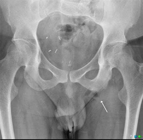 Ischial Pressure Ulcer