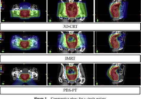 Figure 1 From Clinical Implementation Of Preoperative Short Course Pencil Beam Scanning Proton