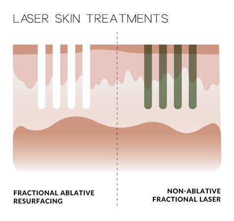 MOXI Laser Treatment In Singapore Lumine Dermatology Laser Clinic