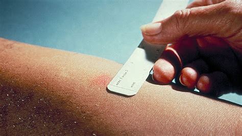 What Does A Positive TB Skin Test Look Like