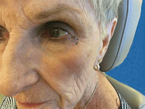 Excision Eye Patient 03 Pasadena And Newport Beach Dr Hung