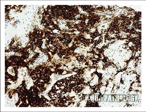 The Darker Staining In Immunohistochemistry Is Positive For Synaptophysin Download Scientific