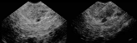 Eus Imaging A Endoscopic Ultrasound Image Of Hypoechoic Area Download Scientific Diagram