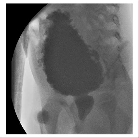 A Voiding Cystourethrogram Revealed Evidence Of A Markedly Thickened Download Scientific