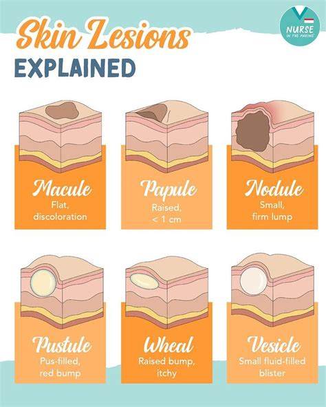 Kristine Tuttle On Instagram 👩‍⚕️skin Lesions Explained🩺 Macule Flat