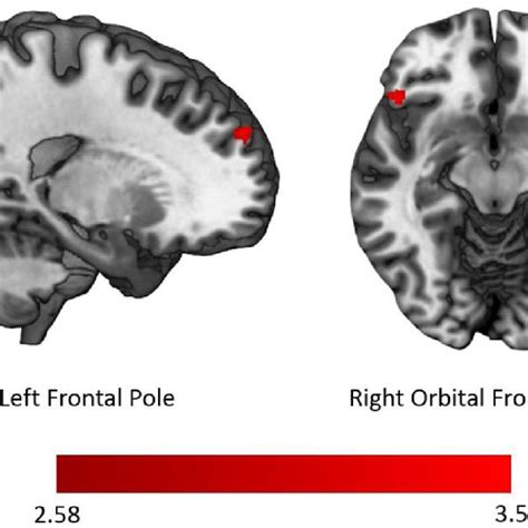 Intranasal Oxytocin Oxt Significantly Augmented The Response To