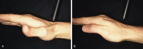 The Role Of Arthroscopy In Midcarpal Instability Clinical Tree
