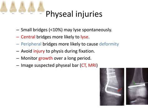 Ppt Common Pediatric Fractures Andtrauma Powerpoint Presentation Free