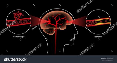 Brain Stroke Hemorrhagic Ischemic Problem Arteriosclerosis เวกเตอร์
