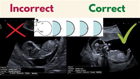 Ultrasound Correct Crown Rump Length Crl Measurement Youtube