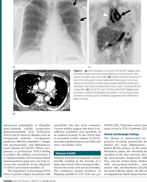 Figure 2 From Imaging Of Pulmonary Vasculitis Semantic Scholar