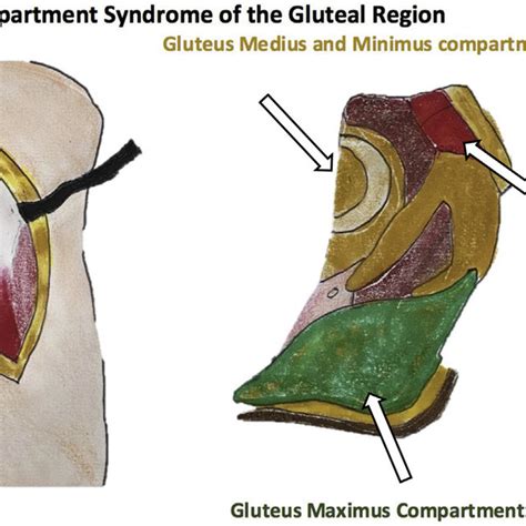 A Fasciotomy Incision Of The Gluteal Region The Patient Is In The Download Scientific Diagram