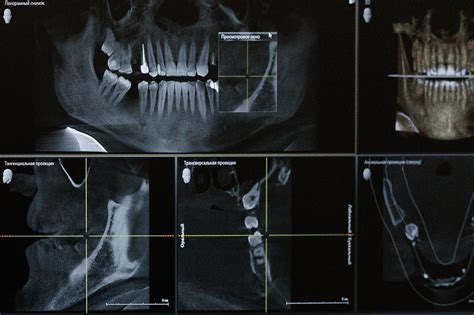 Синус лифтинг Стоматология в Минске