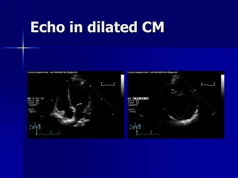 Ppt Cardiomyopathy Powerpoint Presentation Free Download Id1013985