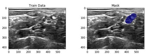 Github Ajaykumar Ultrasound Nerve Segmentation Segmenting The Ultrasound Images To Find