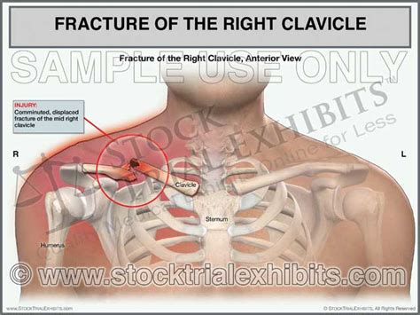 Clavicle Fracture Right Side Male Stock Trial Exhibits