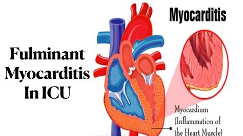 Fulminant Myocarditis In Icu Youtube