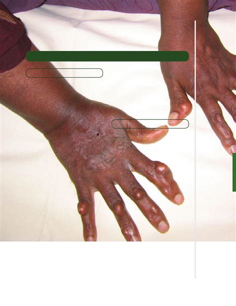 Dyslipidemia Notes Diagrams And Download Pdf Osmosis