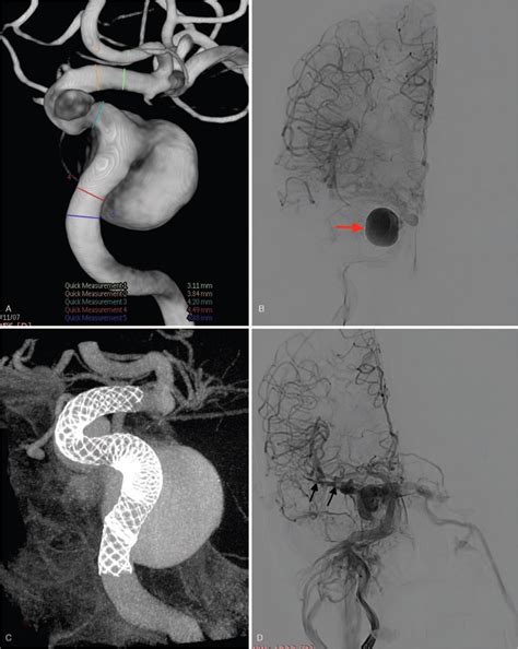 Concomitant Occurrence Of Clinoid And Cavernous Segment Aneu Medicine