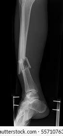 X Ray Image Leg Showing Tibia Fibula Stock Photo 557107630 Shutterstock