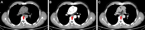 Apatinib Combined With Docetaxel As A Salvage Treatment For Metastatic