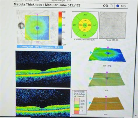 Interpret Oct Scan R Diabetes