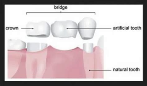 Bridges Treatment Service At Best Price In Bengaluru Id 21628731797