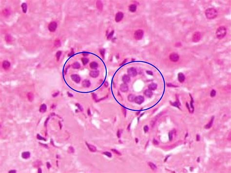 Unpacking Primary Biliary Cholangitis And Its Burden In Japan Research Outreach