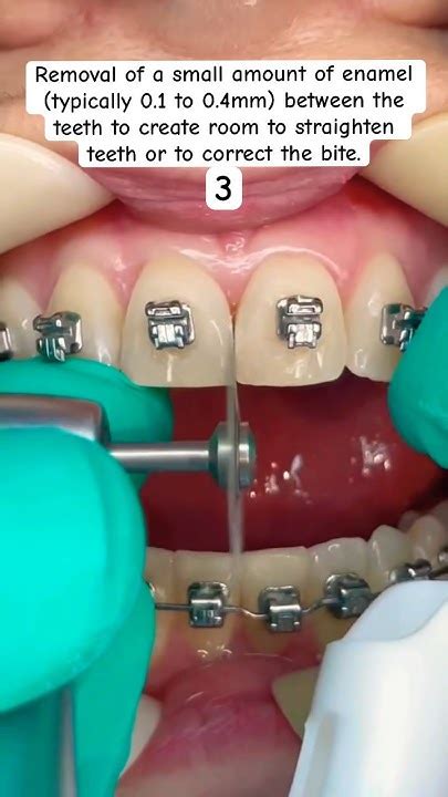 Disking Between Teeth Correction Braces Youtube