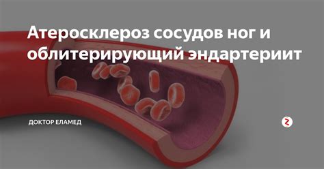 Атеросклероз сосудов ног и облитерирующий эндартериит | Доктор ЕЛАМЕД ...