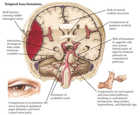 Skysemiology 5 Hérnia De úncus Neurosky