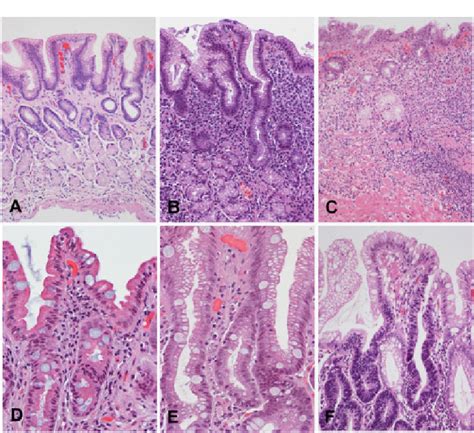 Intestinal Type Adenocarcinoma Semantic Scholar