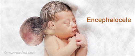 Neural Tube Defects Types Causes Diagnosis And Treatment
