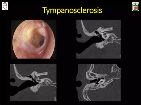Imaging Of The Temporal Bone Pptx
