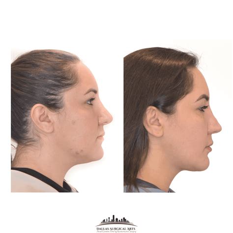 Jaw Repositioning Orthognathic Surgery Dallas Surgical Arts