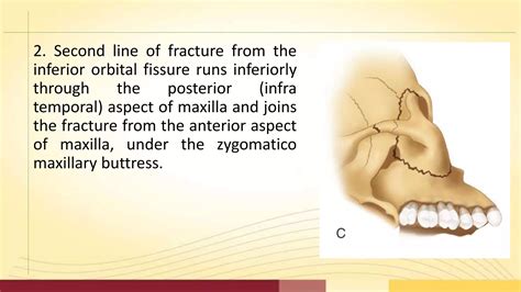 Zmc Fracture Pptx