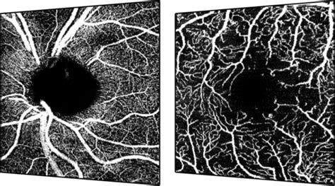 Spectralis Oct Angiography Module Non Invasive Imaging Heidelberg