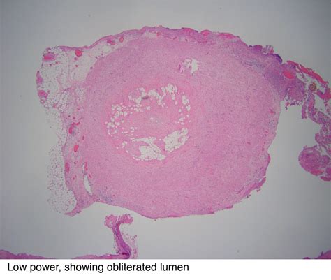 Pathology Outlines Fibrous Obliteration