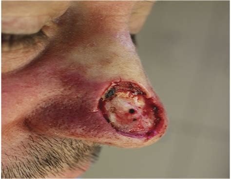Reconstruction Of A Nasal Tip Defect Dermatologic Surgery