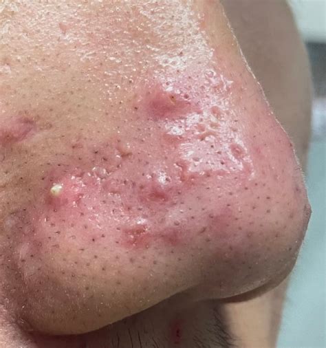 코 여드름 흉터 지식in